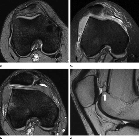 Trochlear Facet Asymmetry Assessed On Axial Fat Saturated T2 Weighted Download Scientific