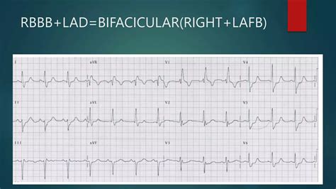 Differentials Of Arrythmias With Rbbb Morphologypptx