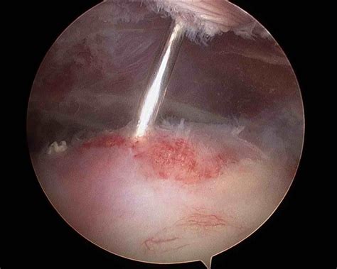Calcific Tendinitis Duncan Tennent