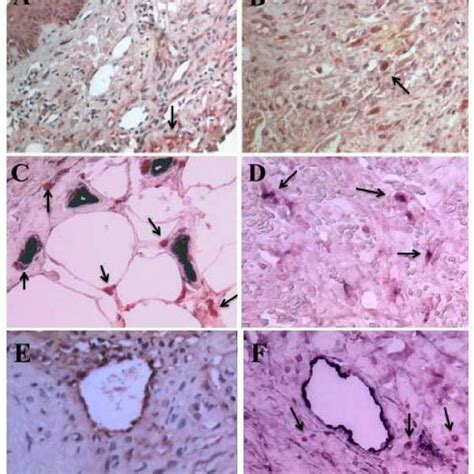 Detection Of Bp1 And Fgf 2 In Kaposis Sarcoma Skin Lesions By
