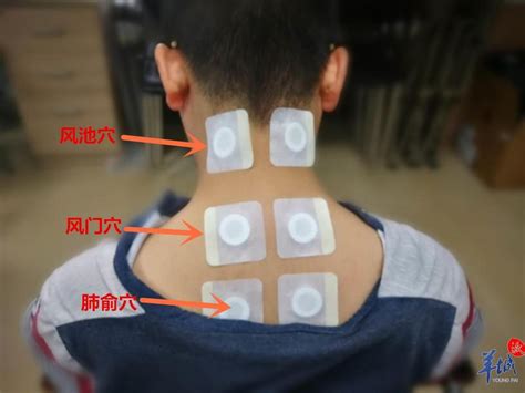 【中医传统疗法】过敏性鼻炎、哮喘试试穴位贴敷