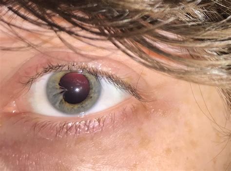 What Is This Iris Defect Called Rophthalmology