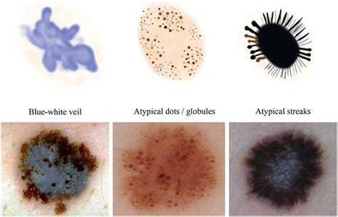 Frontiers Exploring Dermoscopic Structures For Melanoma Lesions