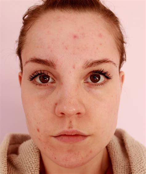 Albums 90 Pictures Pictures Of Acne On The Face Excellent