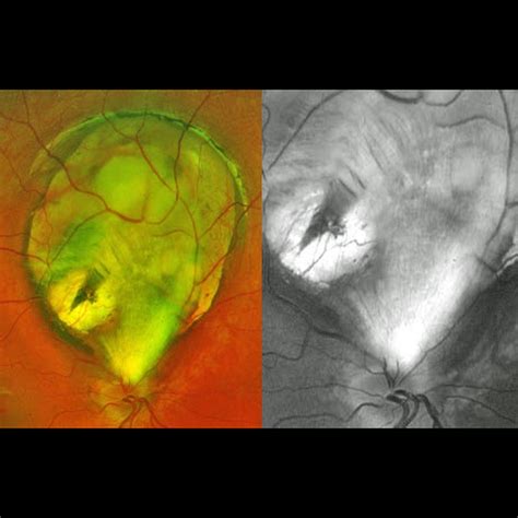 Choroidal Coloboma With Myelinated Nerve Fiber Layer Rwc Retina Rocks