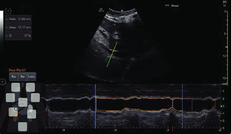 Auto Inferior Vena Cava Collapsibility Index Calculation Using Download Scientific Diagram