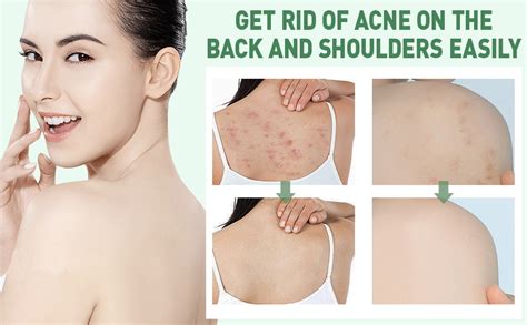 Back Acne Treatment Spray With Herbal Formula 2 Salicylic Acid And Tea Tree Oil