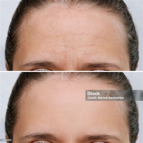 Young Woman With Wrinkles On A Forehead Before And After Face Lift