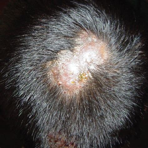 Black Dot Variety Of Tinea Capitis Download Scientific Diagram