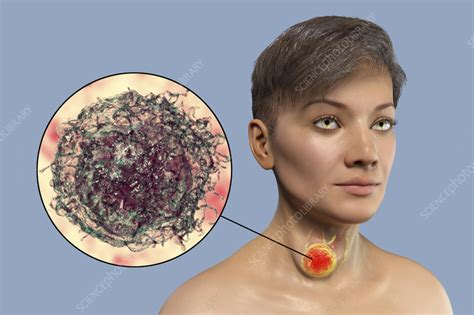 Woman With Thyroid Cancer Illustration Stock Image F038 6019