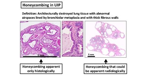 Usual Interstitial Pneumonia Uip Honeycombing And Traction Bronchiectasis