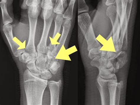 Hamate Fracture X Ray At Rodney Murphy Blog