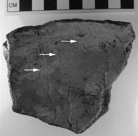 Possible Hyperostosis Frontalis Interna Endocranial Surface Of Frontal Download Scientific