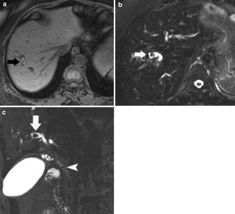 Recurrent Pyogenic Cholangitis Axial T1 Weighted Fat Sat Pre Contrast