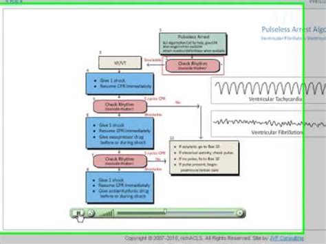 Pulseless Ventricular Tachycardia Ecg