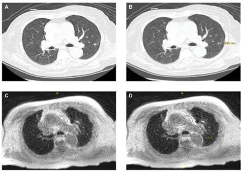 Axial Sections Of Computed Tomography Chest And Magnetic Resonance