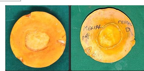 Figure 1 From Prosthetic Rehabilitation Of An Ocular Defect A Case