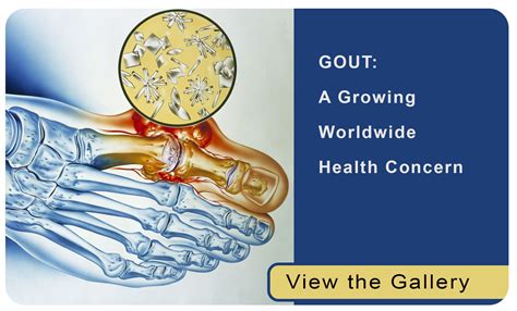Gout A Growing Health Concern — Science And Medical Stock Images
