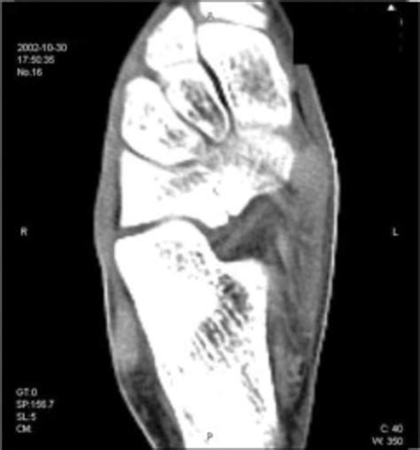 Tomographic Section Showing Cuboid Navicular Coalition Download Scientific Diagram