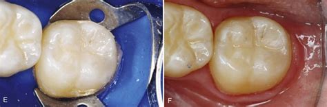 10 Class I Ii And Vi Direct Composite Restorations And Other Tooth