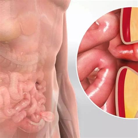 Hernia Inguinal Feminina Female Inguinal Hernia Appearance A Simple