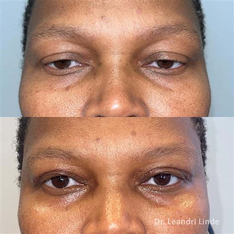 Droopy Eyelid Ptosis Treatment Cape Town South Africa