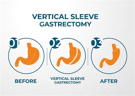 Premium Vector Laparoscopic Sleeve Gastrectomy Vertical Gastrectomy