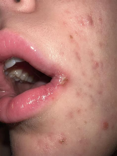 Cold Sore R Accutane
