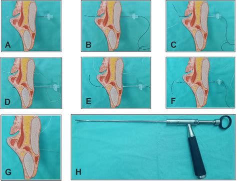 Lateralization Suture Placement Can Be Performed By Trans Cervical Download Scientific Diagram