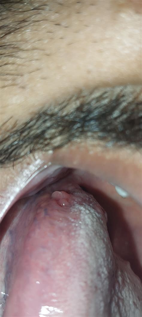 Is This Normal Foliate Papillae Rdentistryedu