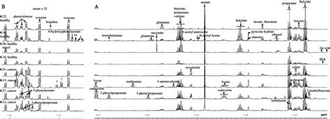 Typical 600 Mhz 1 H Nmr Spectra Of Aqueous Faecal Extracts From 4 Crc
