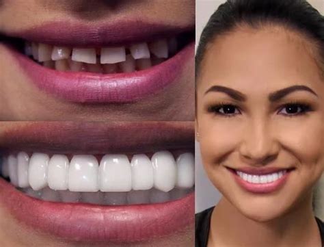 Teeth Treat Ada Teeth Whitening Facts
