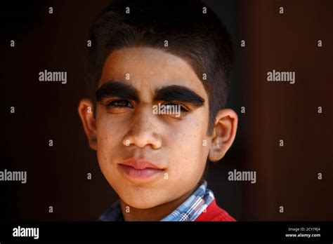 Hypertrichosis Treatment Before And After