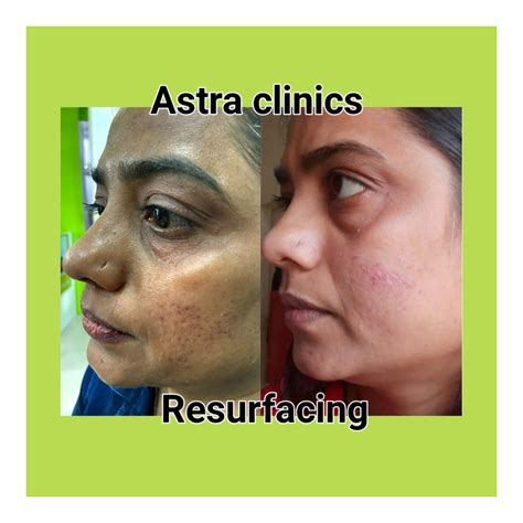 Post Acne Scar Removal In Pune Laser Treatment For Acne Scar In Pune