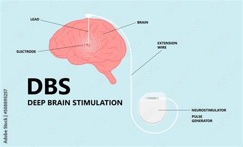 Deep Brain Stimulation Or Dbs Treat Parkinsons Disease Pd And Tms Condition Major Neural