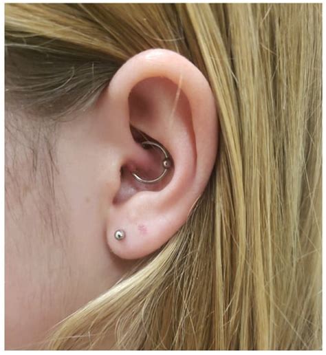 Perceptions Regarding Daith Piercing In Migraine A Survey Of Pediatric