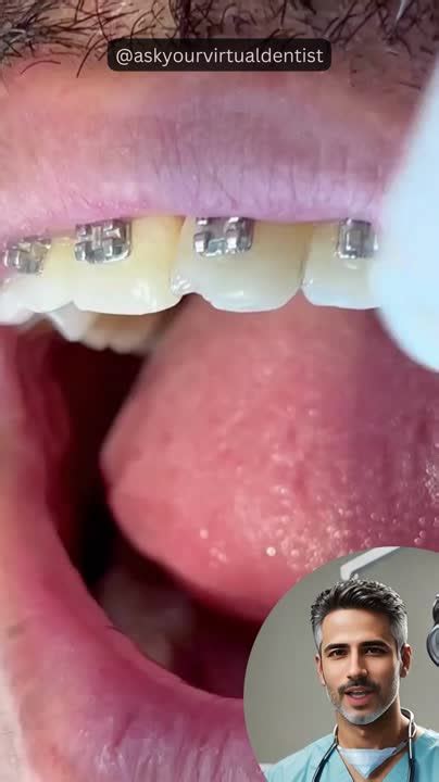 Askyourvirtualdentist On Linkedin Ipr Dental Procedure Creating Space For Straighter Teeth