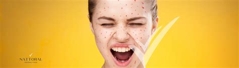 Pimple Problems How Long Do They Last And How To Manage Them Nattoral