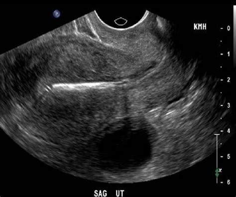 Why Gynecologists Think Iuds Are The Best Contraceptive Vox