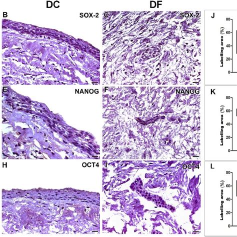 Comparative Immunoexpression Of Sox 2 Nanog And Oct4 In Ame Dc And Df