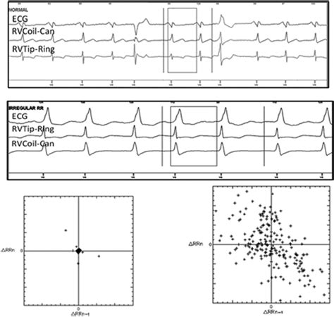 Ecg Egm And Corresponding Lorenz Plots The Top Ecg Figure Is Of Normal