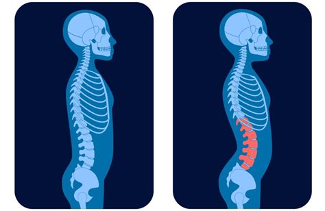 Что такое лордоз причины симптомы лечение Rubinko