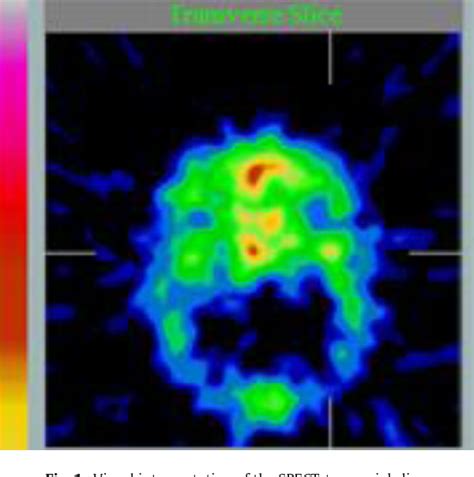 Figure 1 From Comparison Of 99mtc Mdp Spect Qualitative Vs Quantitative Results In Patients With