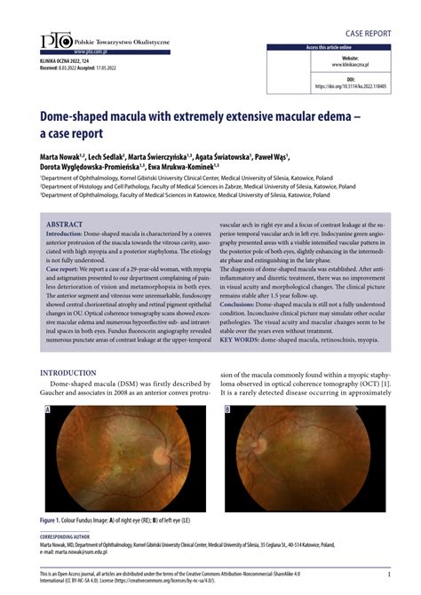 Pdf Dome Shaped Macula With Extremely Extensive Macular Edema