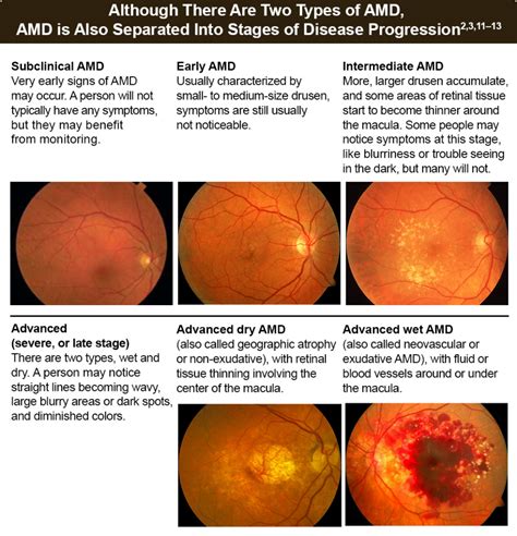 Stages Of Amd Amd Patient And Caregiver