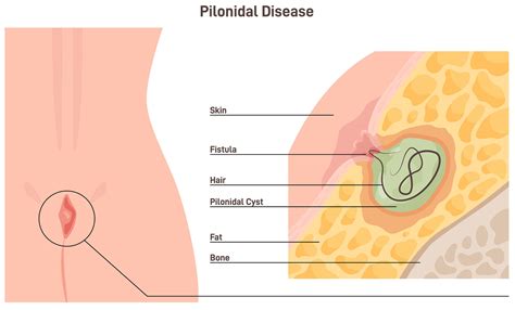 Pilonidal Cysts And Abscess Dr Neeraj Singh Md Facs Fascrs