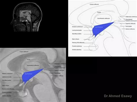 Mri Imaging Hypothalamus Dr Ahmed Esawy Pdf