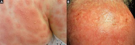 Diffuse Erythematous Rash