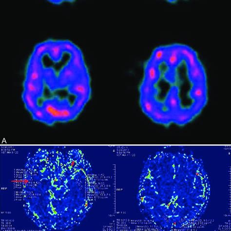 A And B A SPECT Images Case Show Reduced Perfusion In Download Scientific Diagram