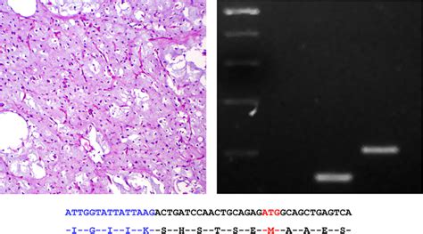 Case No 9 The Upper Left Panel Shows The Classic Myxoid Liposarcoma